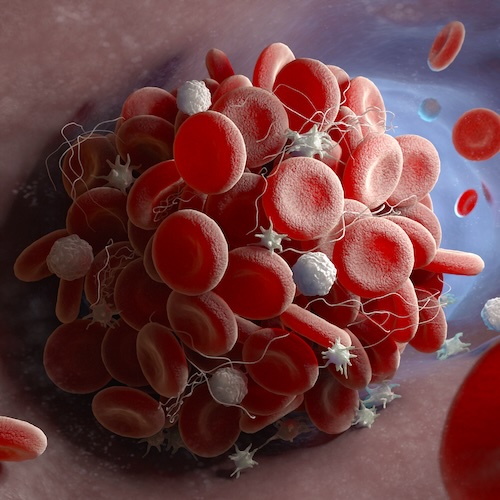 Stent ou pontage ? Comment pouvons-nous nous protéger d’une crise ...