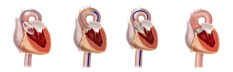 TAVI | Prof. Dr. Tayfun Aybek